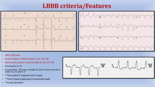 Left Bundle Branch Block (LBBB) | PPTX