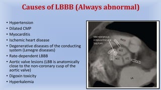 Left Bundle Branch Block (LBBB) | PPTX