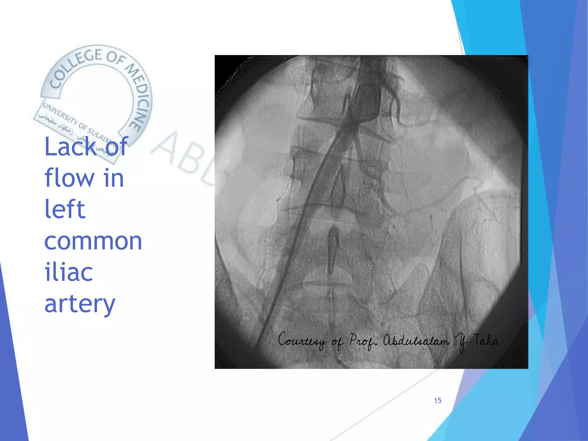 Left Common Iliac Artery Occlusion.pdf