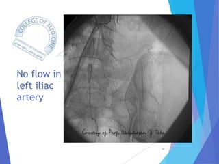 Left Common Iliac Artery Occlusion.pdf