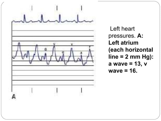Left heart catheterization dr. nazmun ara | PPTX