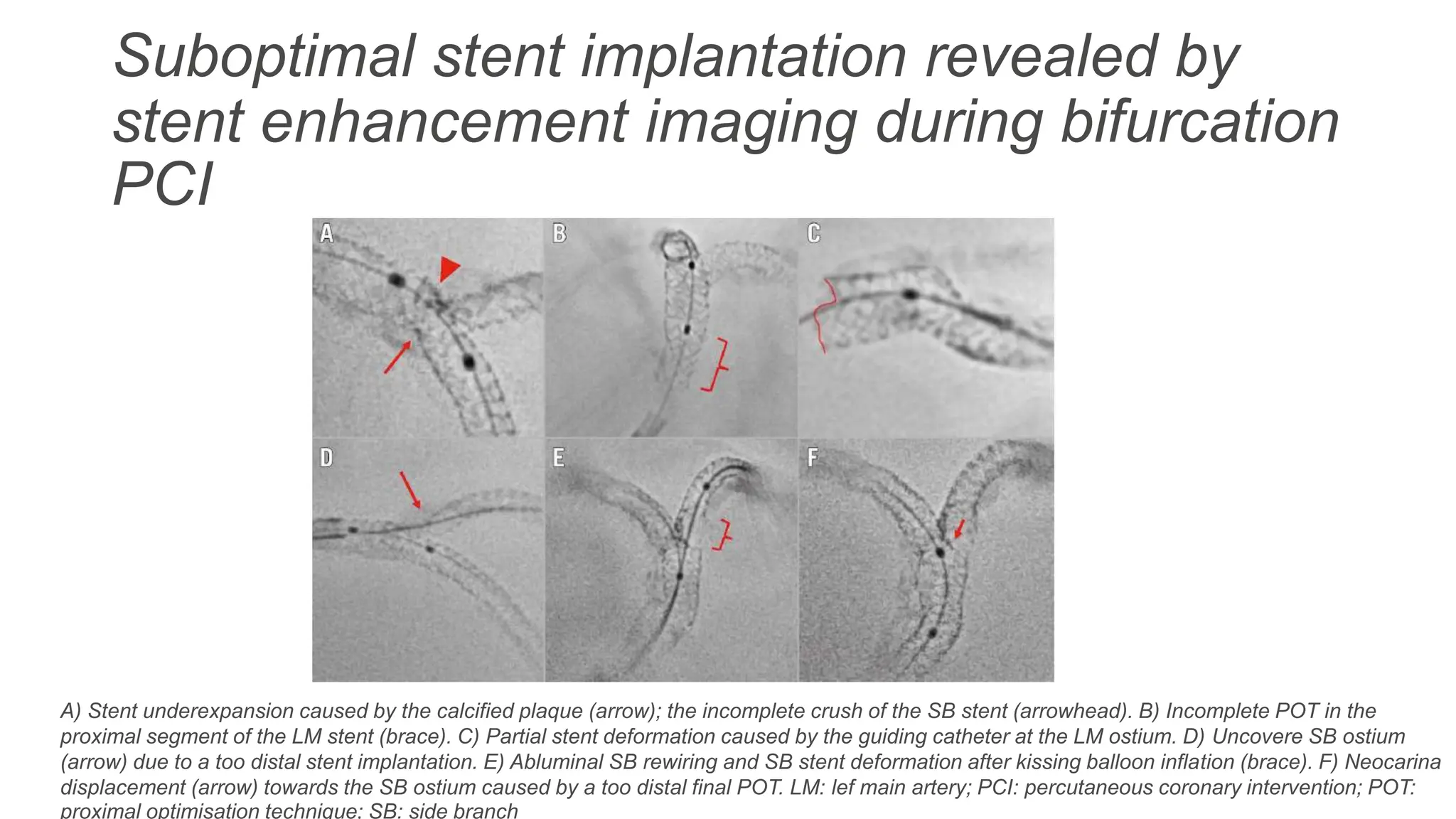 LEFT MAIN BIFURCATION STENTING EBC 2024.pptx