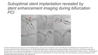 LEFT MAIN BIFURCATION STENTING EBC 2024.pptx | Heart and Cardiovascular ...