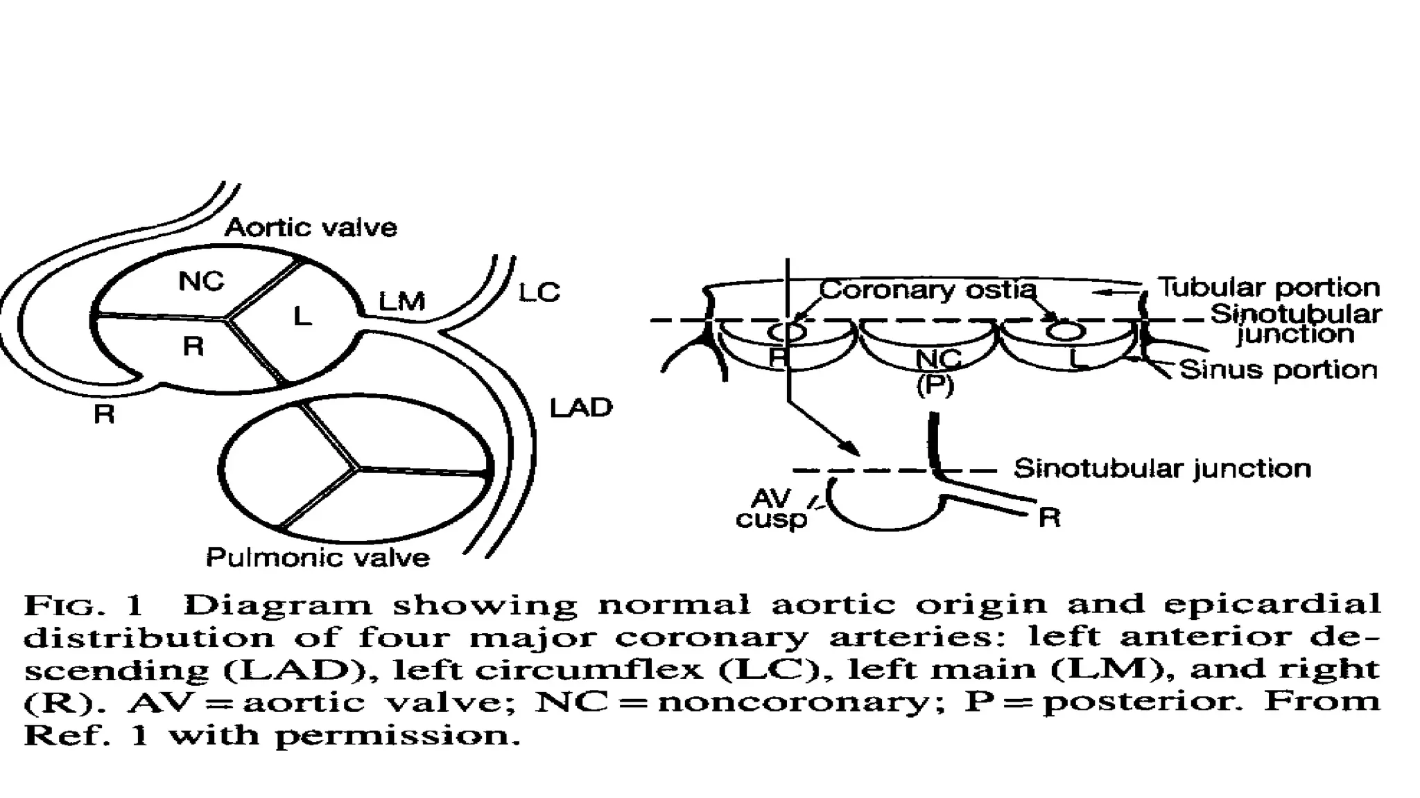 Left main disease final | PPTX | Heart and Cardiovascular Diseases ...