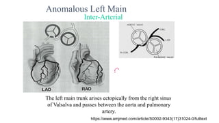 Left main disease final | PPTX | Heart and Cardiovascular Diseases ...