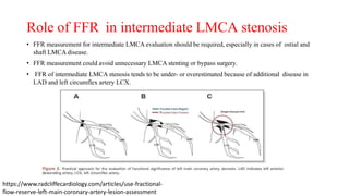 Left main disease final | PPTX | Heart and Cardiovascular Diseases ...