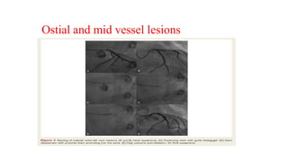 Left main disease final | PPTX | Heart and Cardiovascular Diseases ...