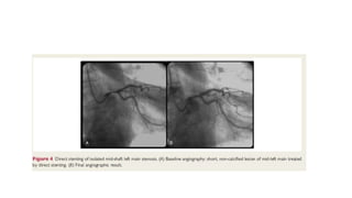 Left main disease final | PPTX