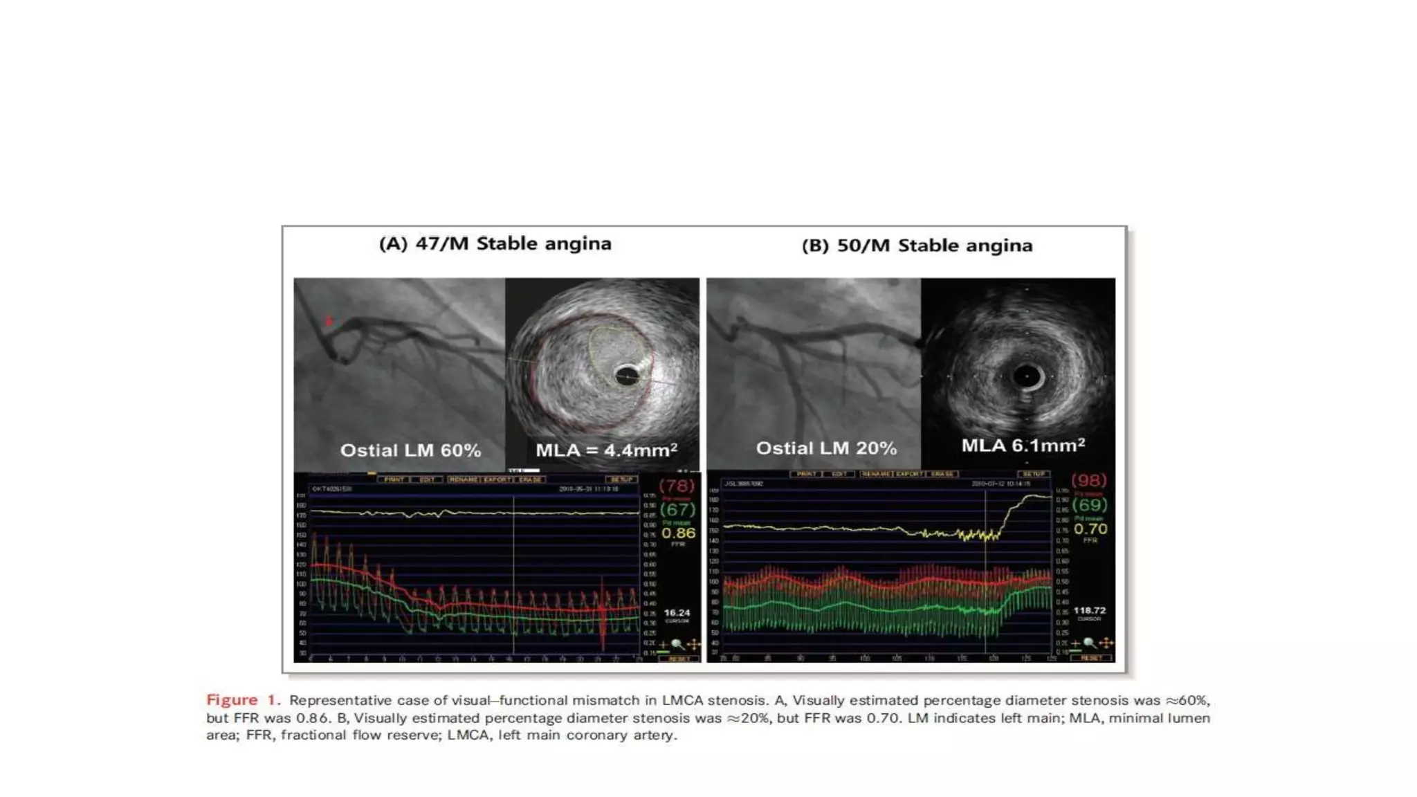 Left main stenting | PPTX