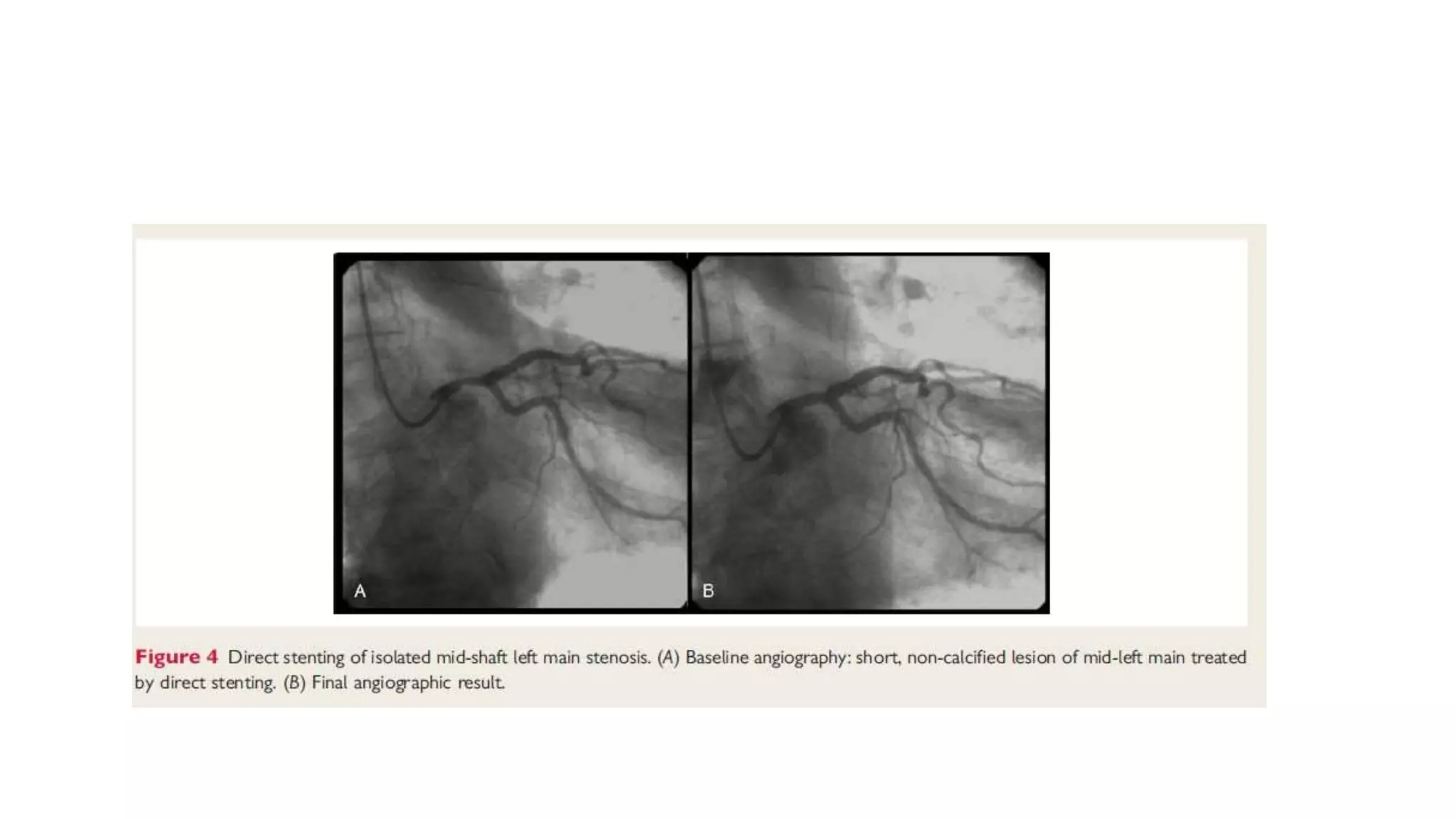 Left main stenting | PPTX