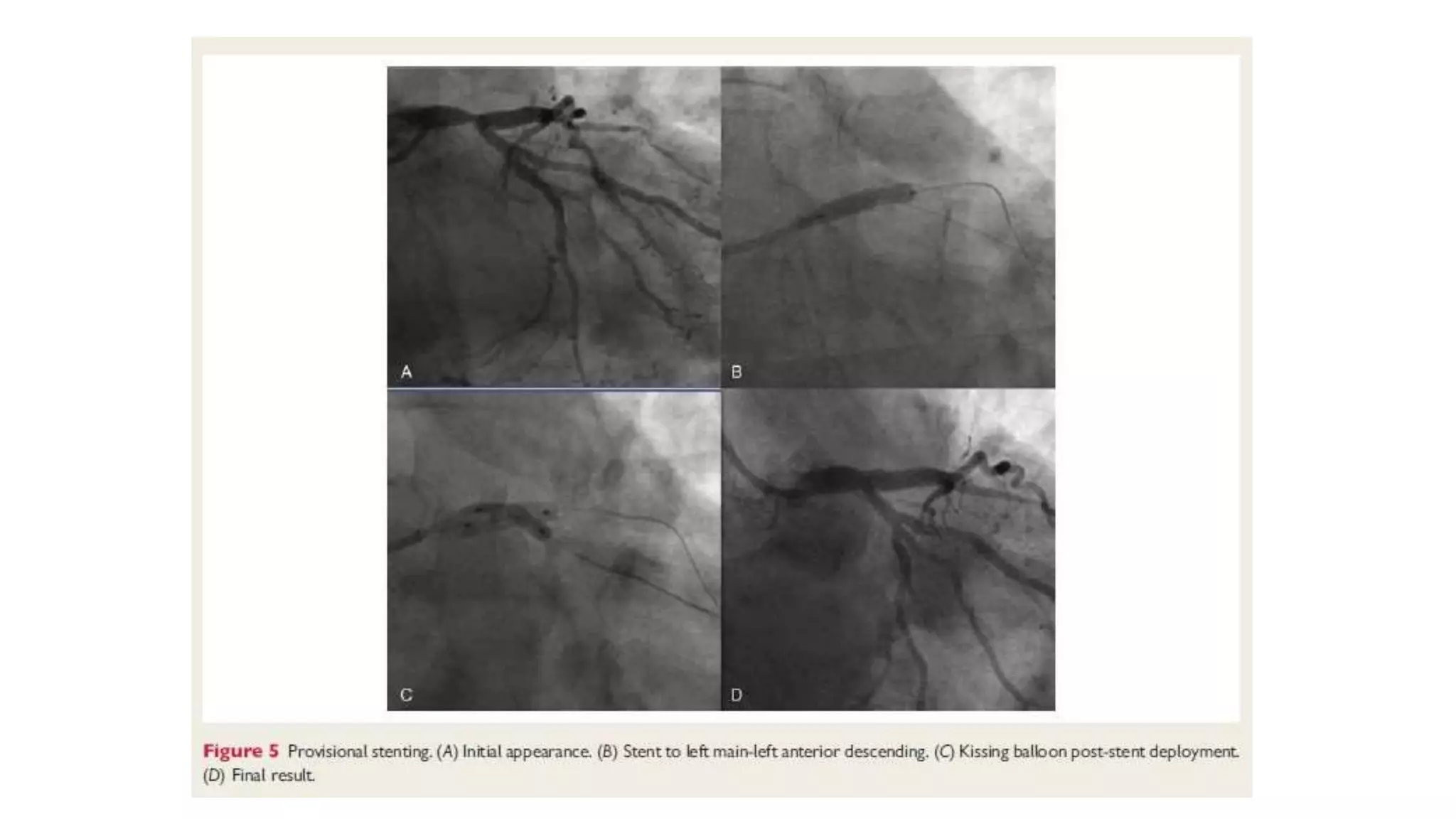 Left main stenting | PPTX
