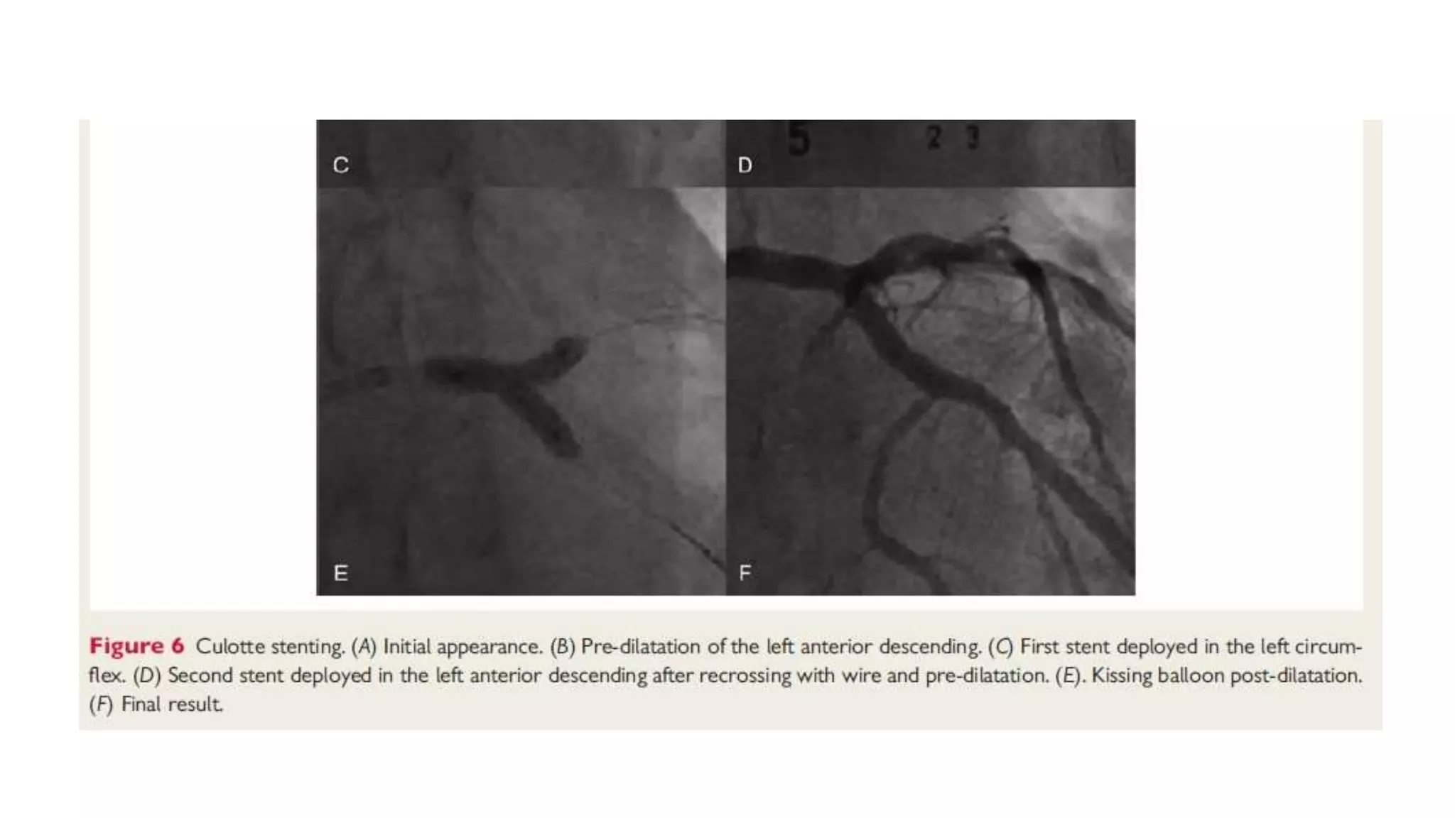 Left main stenting | PPTX
