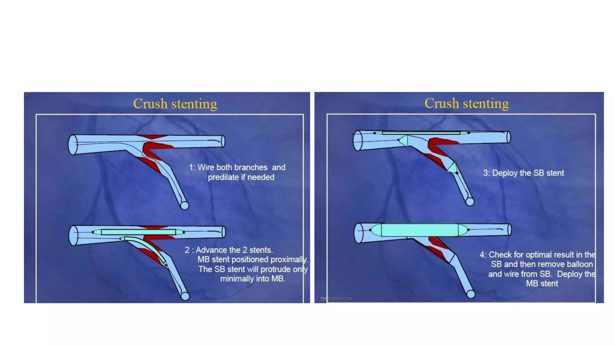 Left main stenting | PPTX