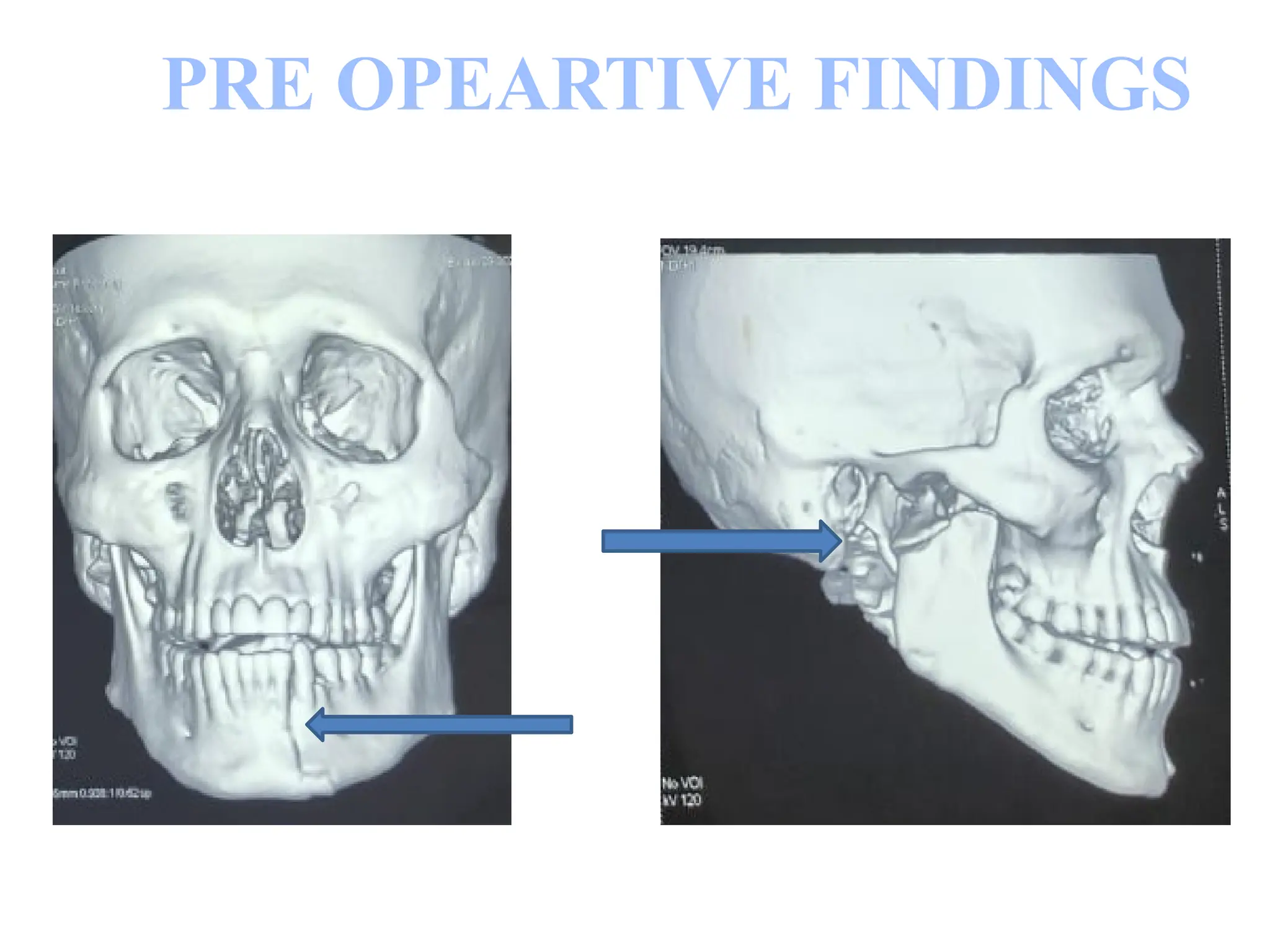 left parasymphysis fract,b,bbure cp.pptx