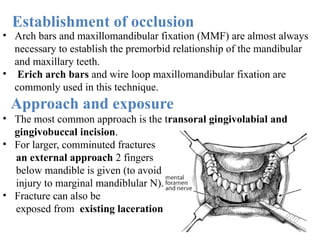 left parasymphysis fract,b,bbure cp.pptx