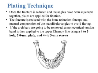 left parasymphysis fract,b,bbure cp.pptx
