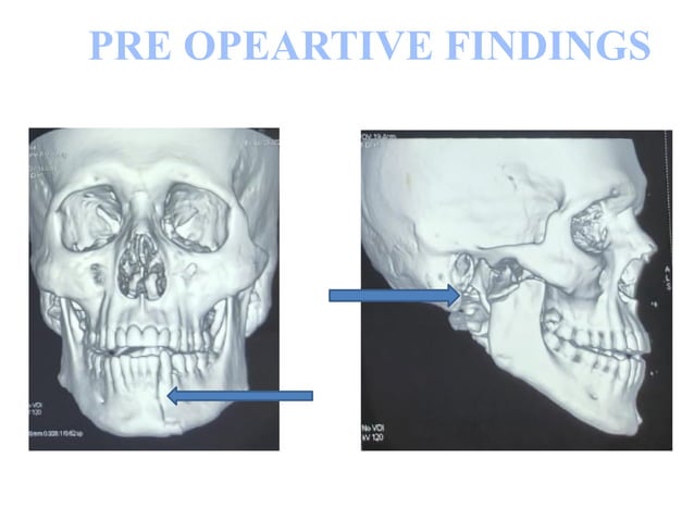 left parasymphysis fract,b,bbure cp.pptx