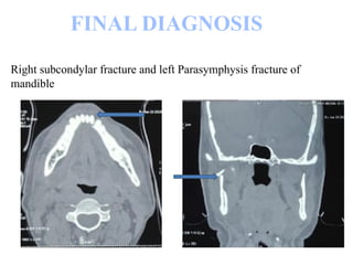 left parasymphysis fract,b,bbure cp.pptx