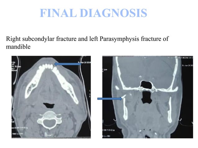 left parasymphysis fract,b,bbure cp.pptx