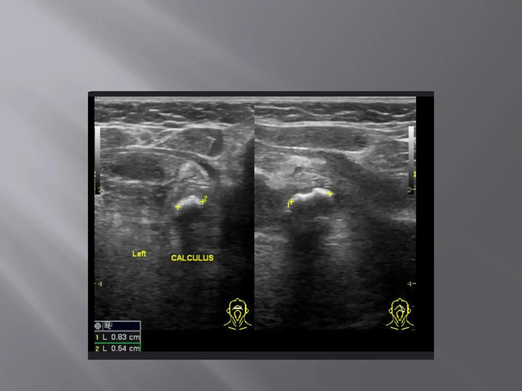 LEFT SUBMANDIBULAR SIALOTHISIS WITH SIALADENITIS | PPTX
