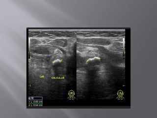 LEFT SUBMANDIBULAR SIALOTHISIS WITH SIALADENITIS | PPTX
