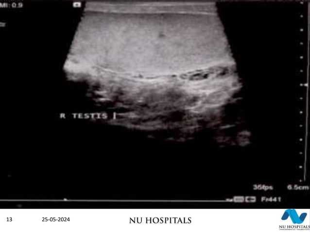 left testicular swelling of the left testis urology ppt | PPT