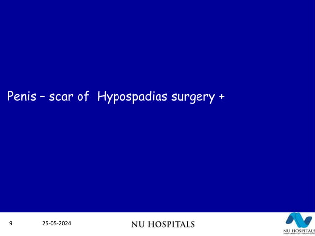 left testicular swelling of the left testis urology ppt | PPT
