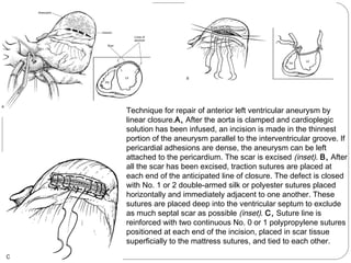 Leftventricularaneurysm 130208122724-phpapp02 | PPT