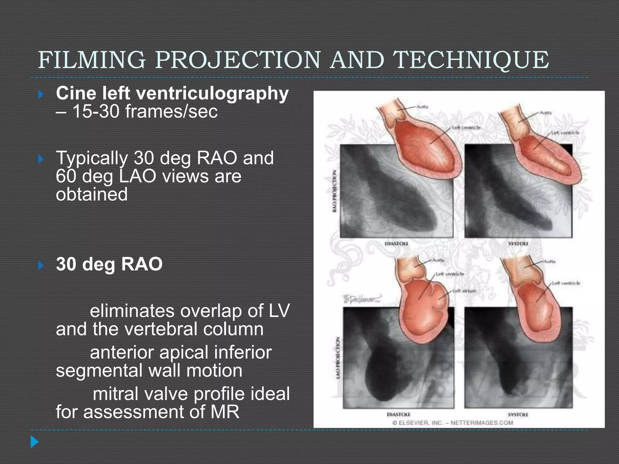Left ventricular angiogram (1) | PPTX