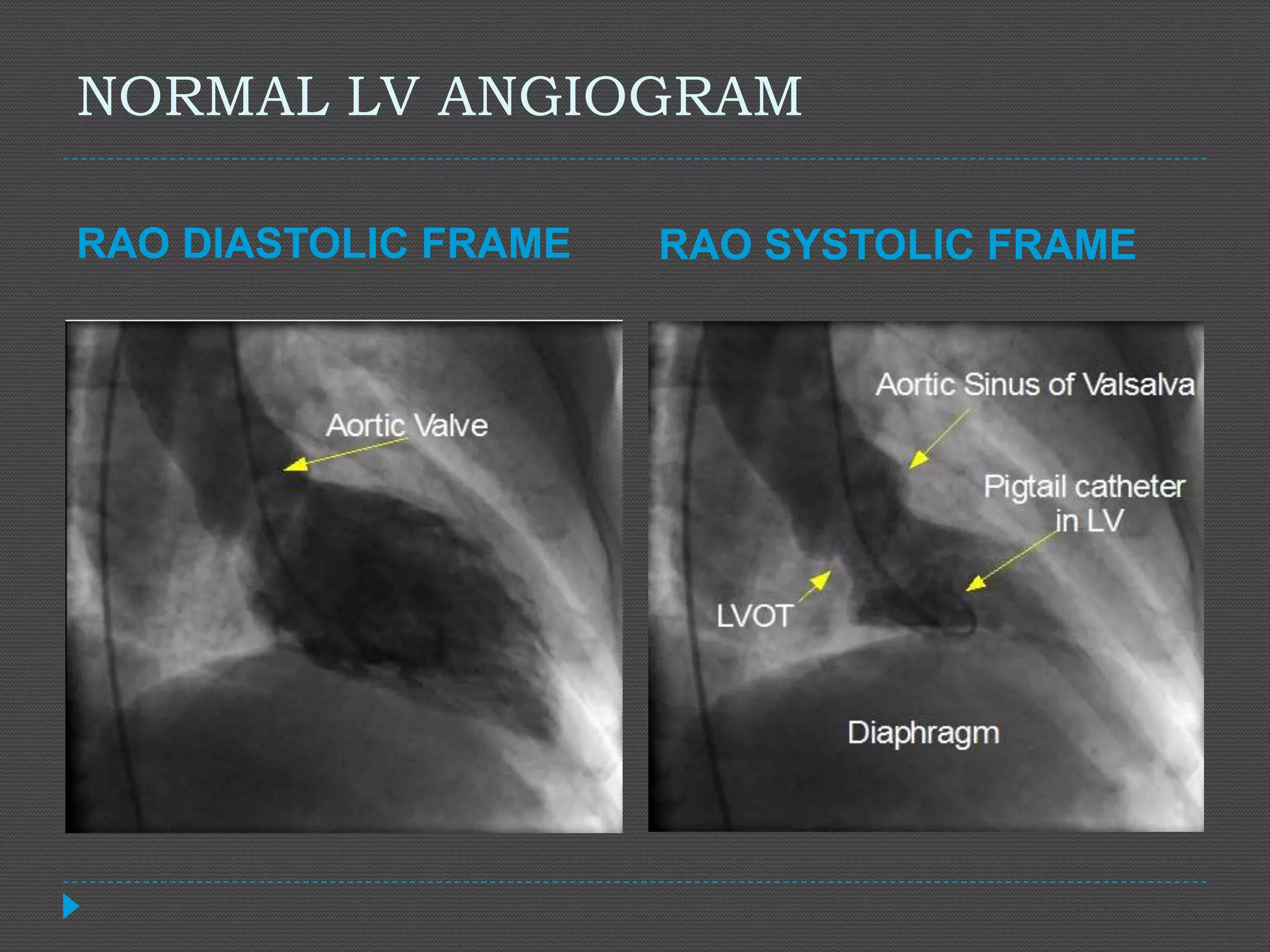 Left ventricular angiogram (1) | PPTX