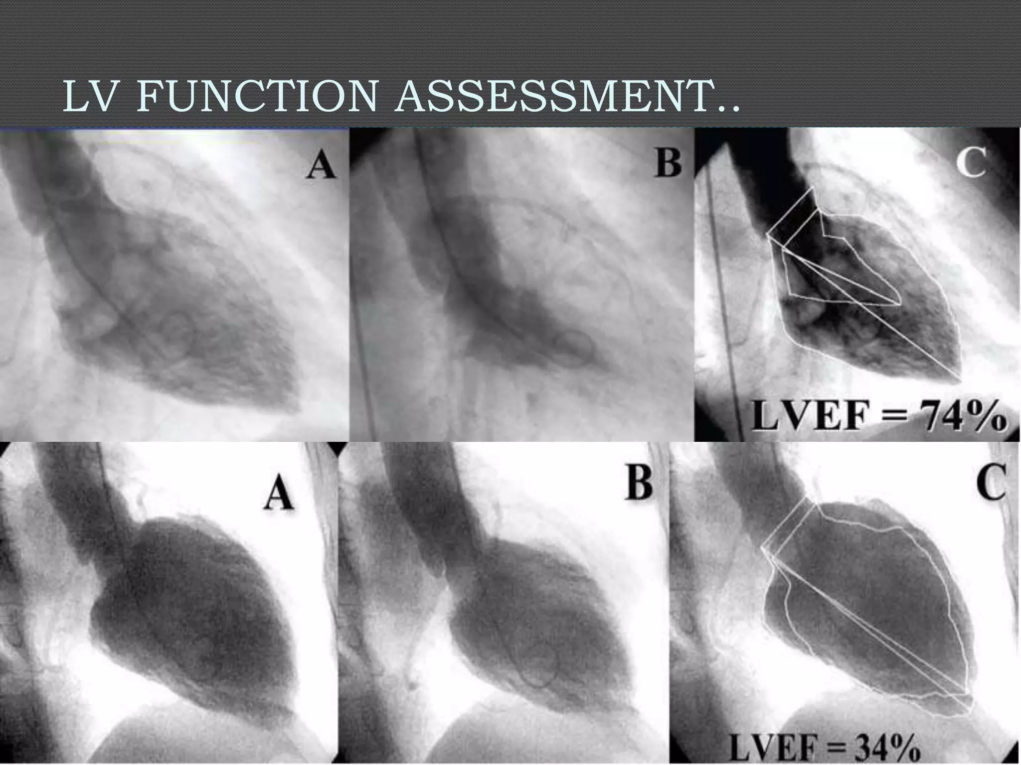 Left ventricular angiogram (1) | PPTX