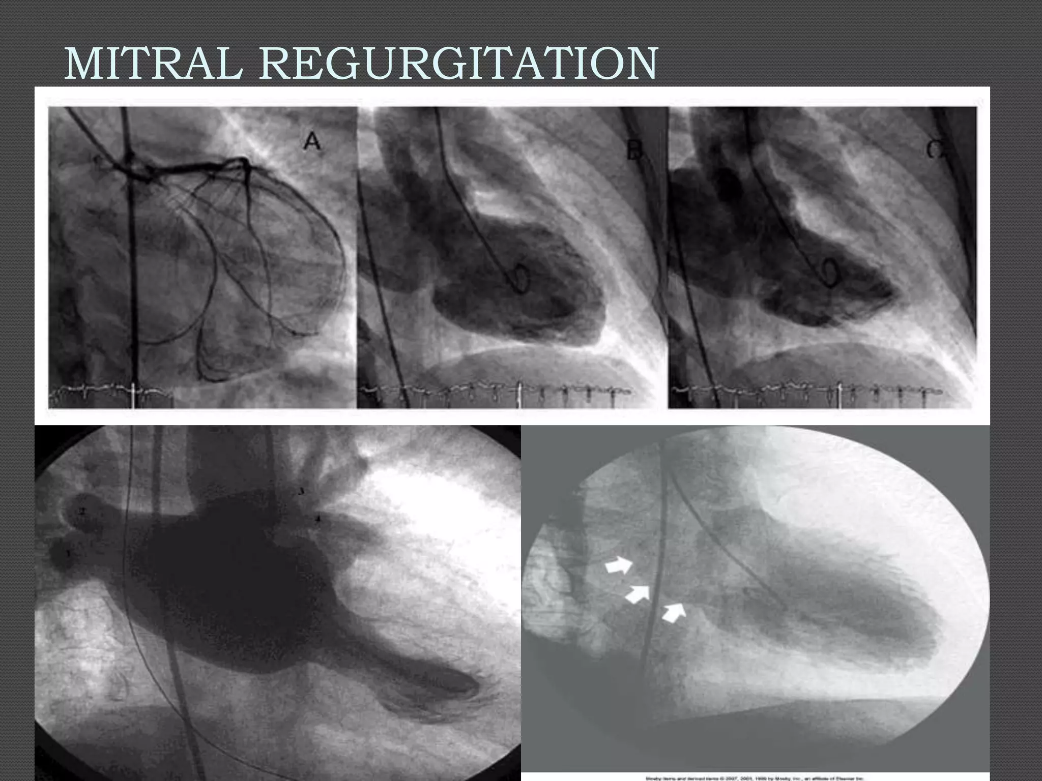 Left ventricular angiogram (1) | PPTX