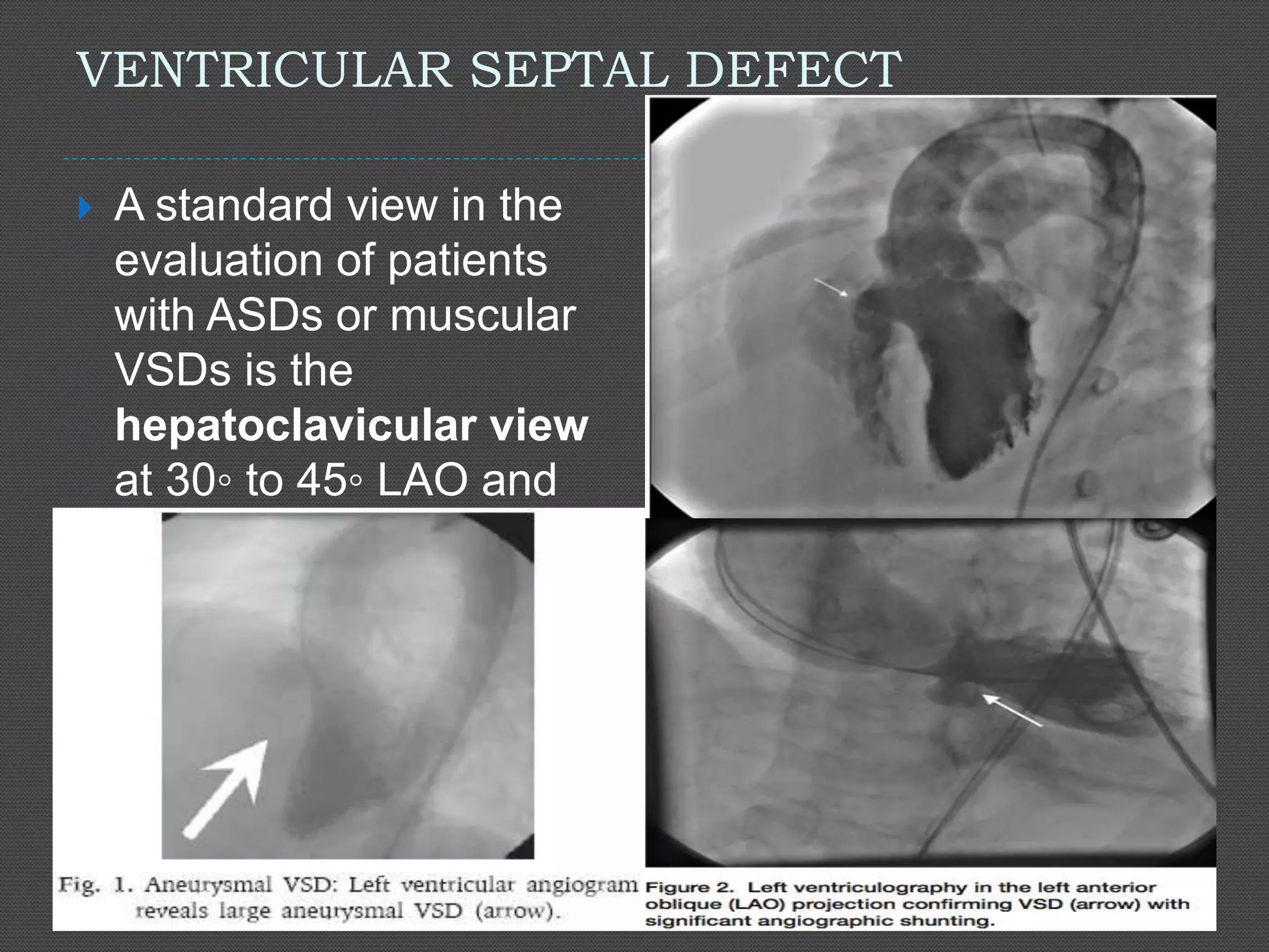 Left ventricular angiogram (1) | PPTX