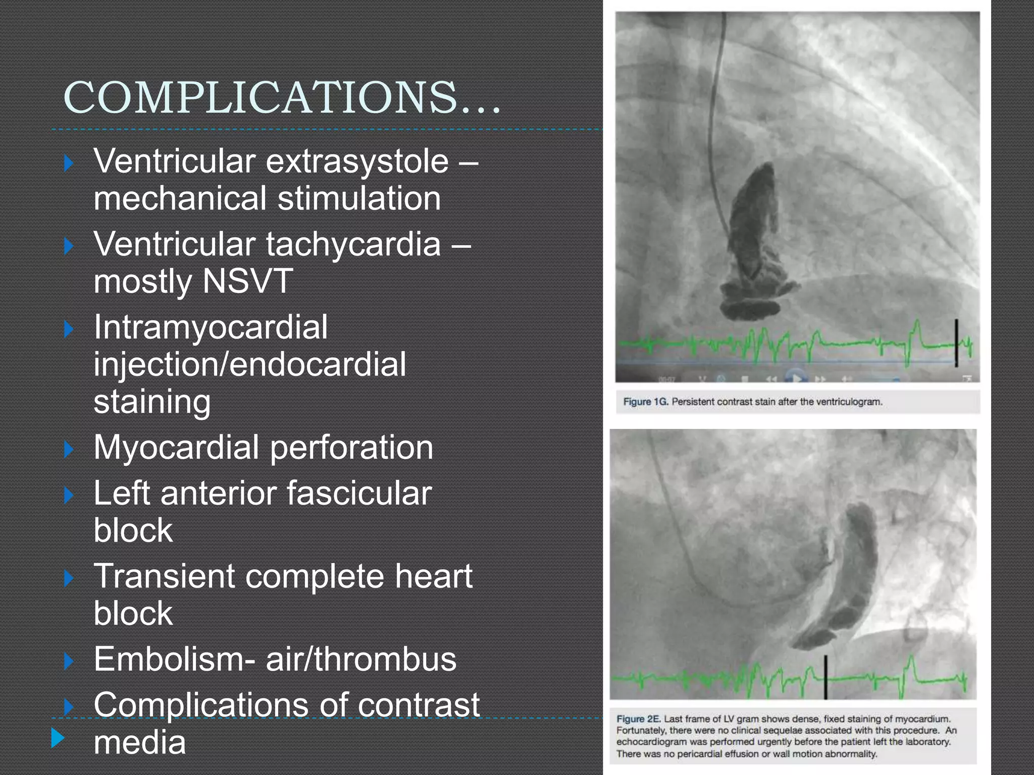 Left ventricular angiogram (1) | PPTX