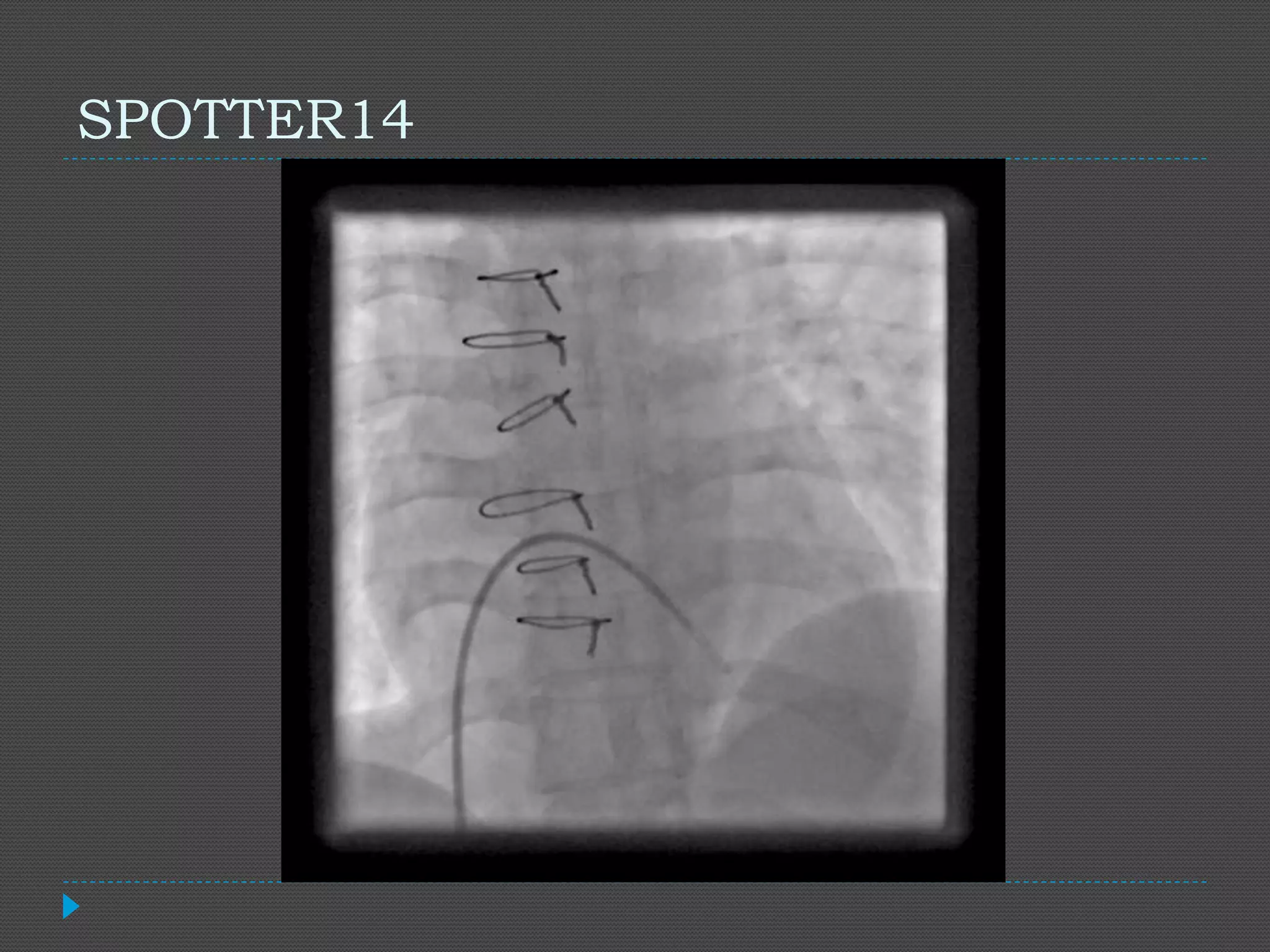 Left ventricular angiogram (1) | PPTX