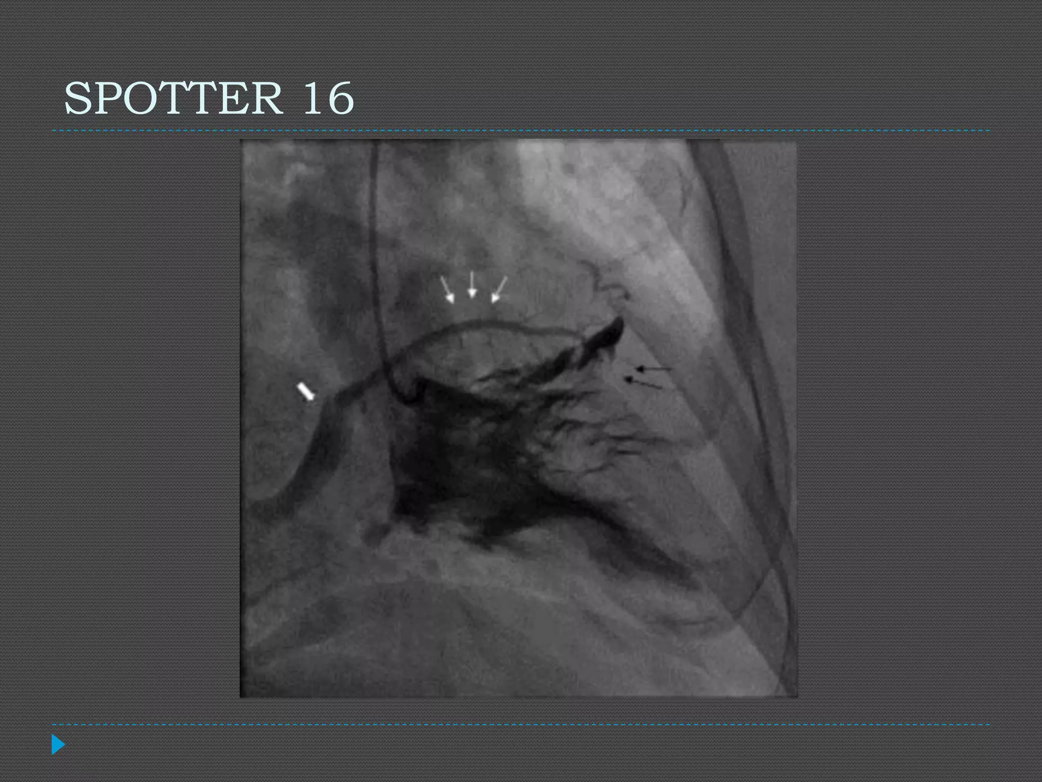 Left ventricular angiogram (1) | PPTX