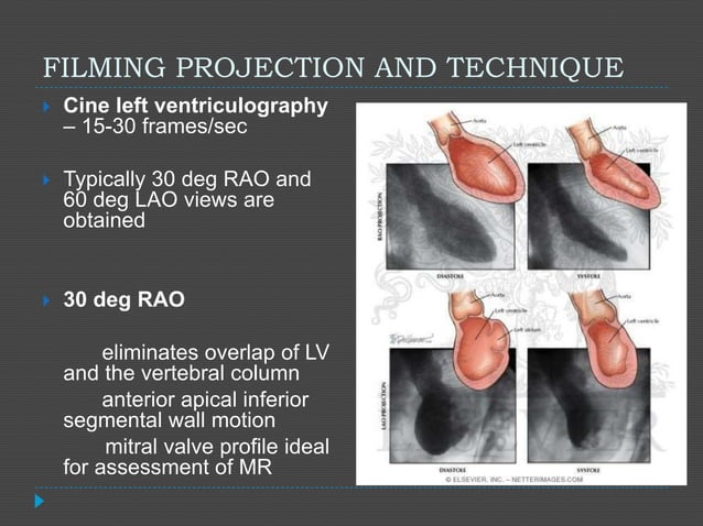 Left ventricular angiogram (1) | PPTX | Heart and Cardiovascular ...