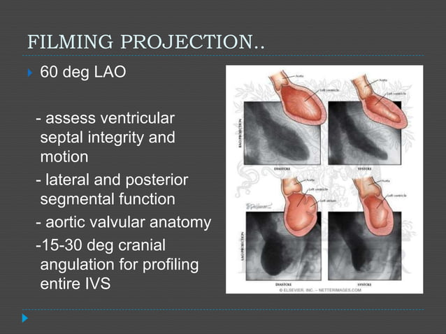 Left ventricular angiogram (1) | PPTX | Heart and Cardiovascular ...