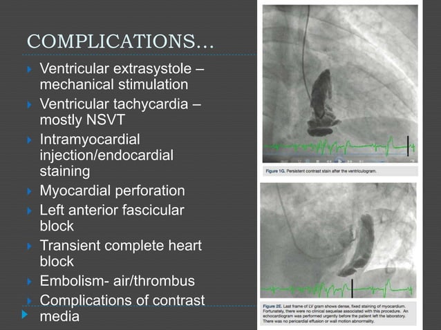 Left ventricular angiogram (1) | PPTX | Heart and Cardiovascular ...