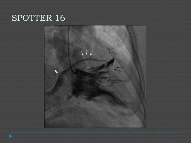 Left ventricular angiogram (1) | PPTX | Heart and Cardiovascular ...