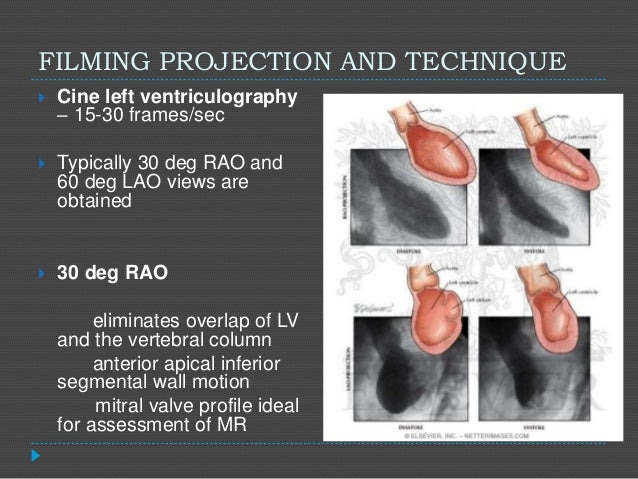 Left ventricular angiogram (1)