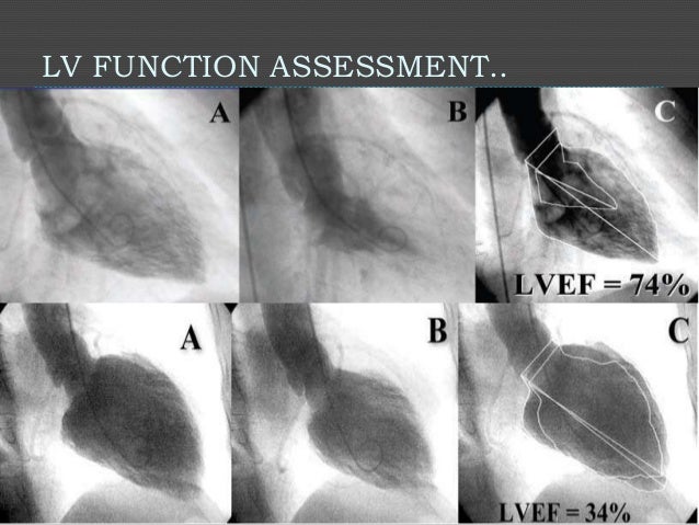 Left ventricular angiogram (1)