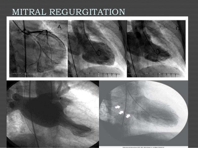 Left ventricular angiogram (1)