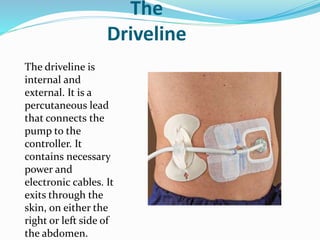lvad 7-1 | PPTX