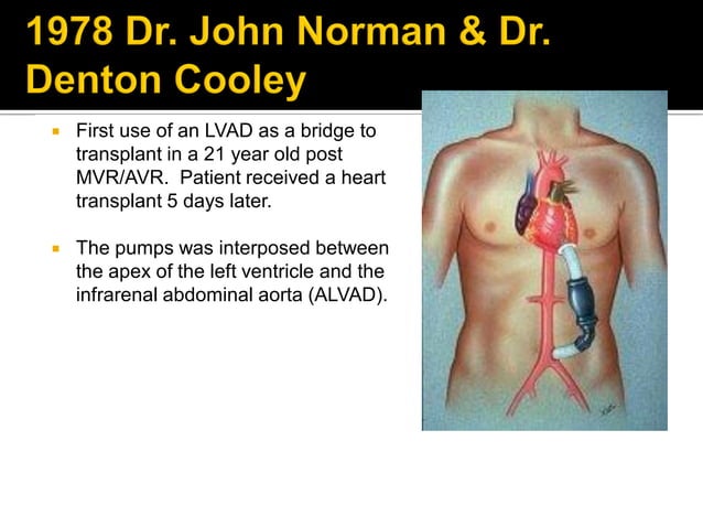 Left ventricular assist devices | PDF | Heart and Cardiovascular Diseases | Diseases and Conditions