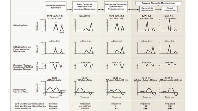 Left ventricular diastolic dysfunction in echocardiography | PPTX ...