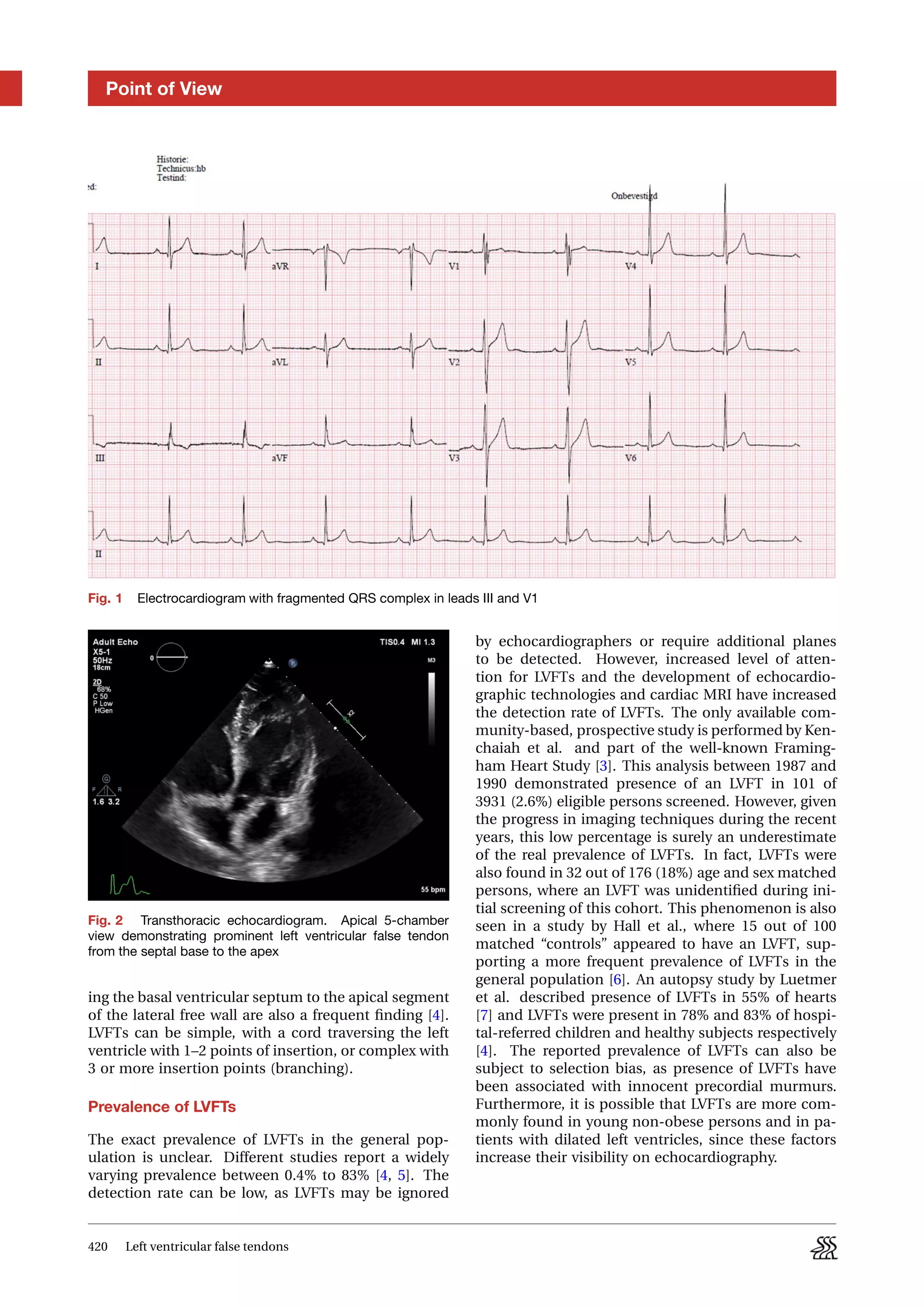 Left ventricular false tendons | PDF