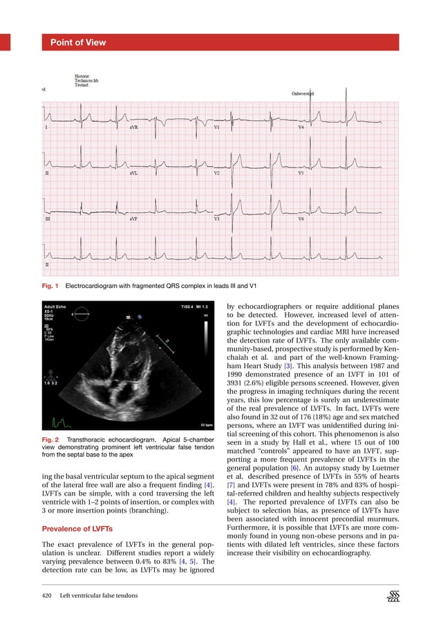 Left ventricular false tendons | PDF