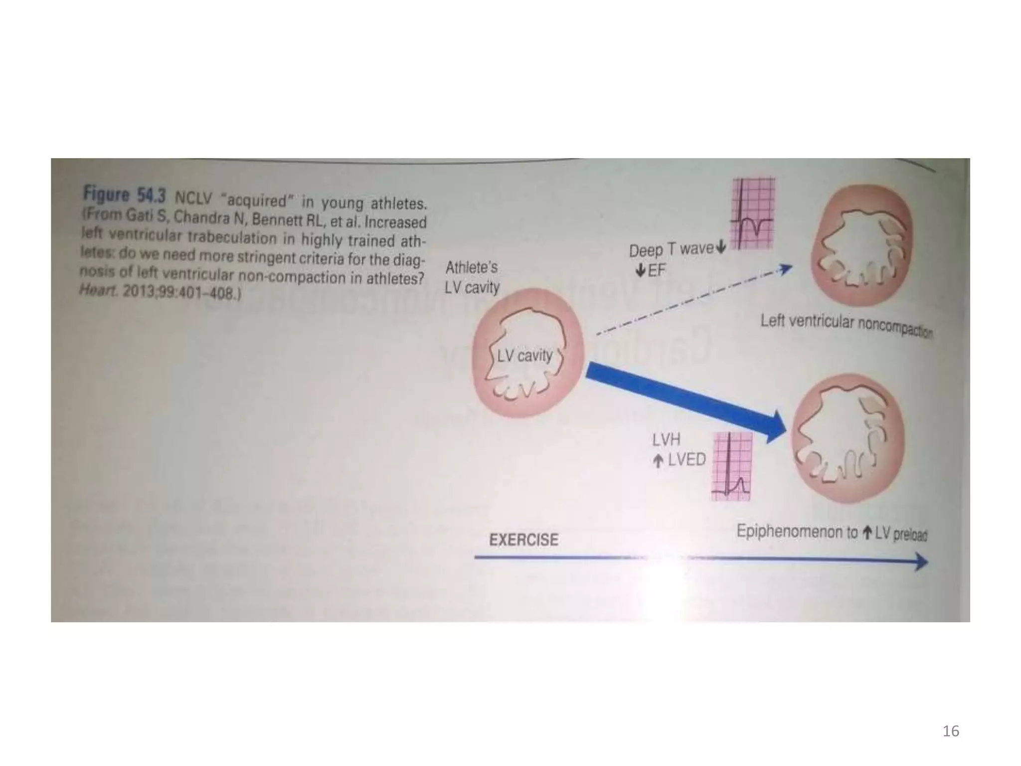 Left ventricular non compaction | PPTX