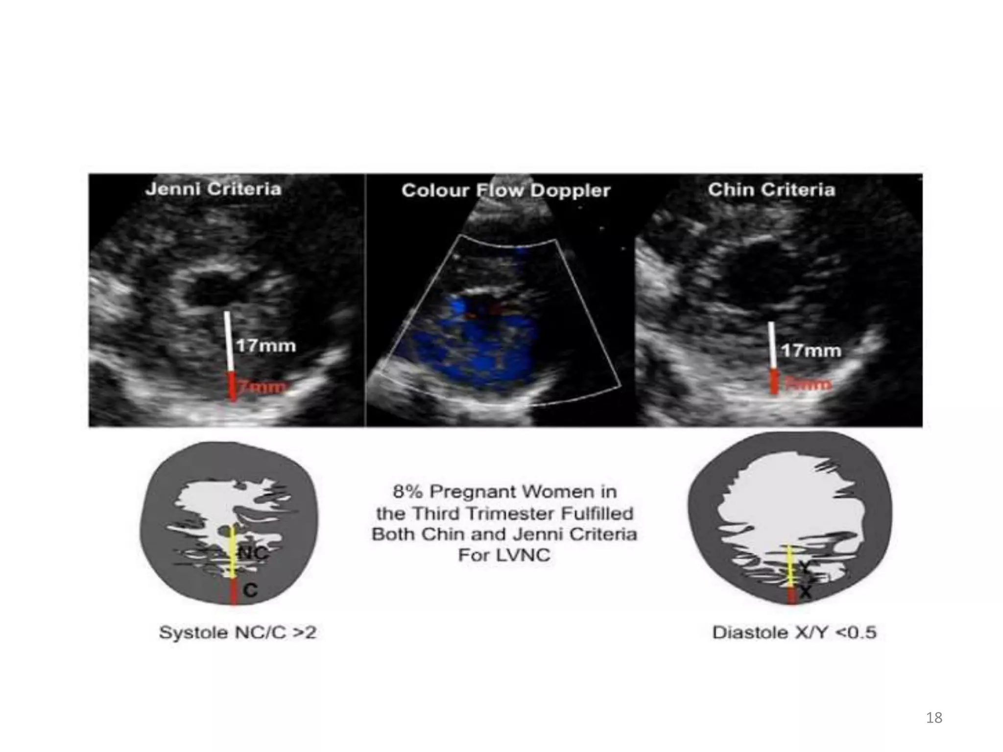 Left ventricular non compaction | PPTX